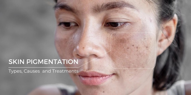 Understanding Skin Pigmentation: Types, Causes, and Treatments ...